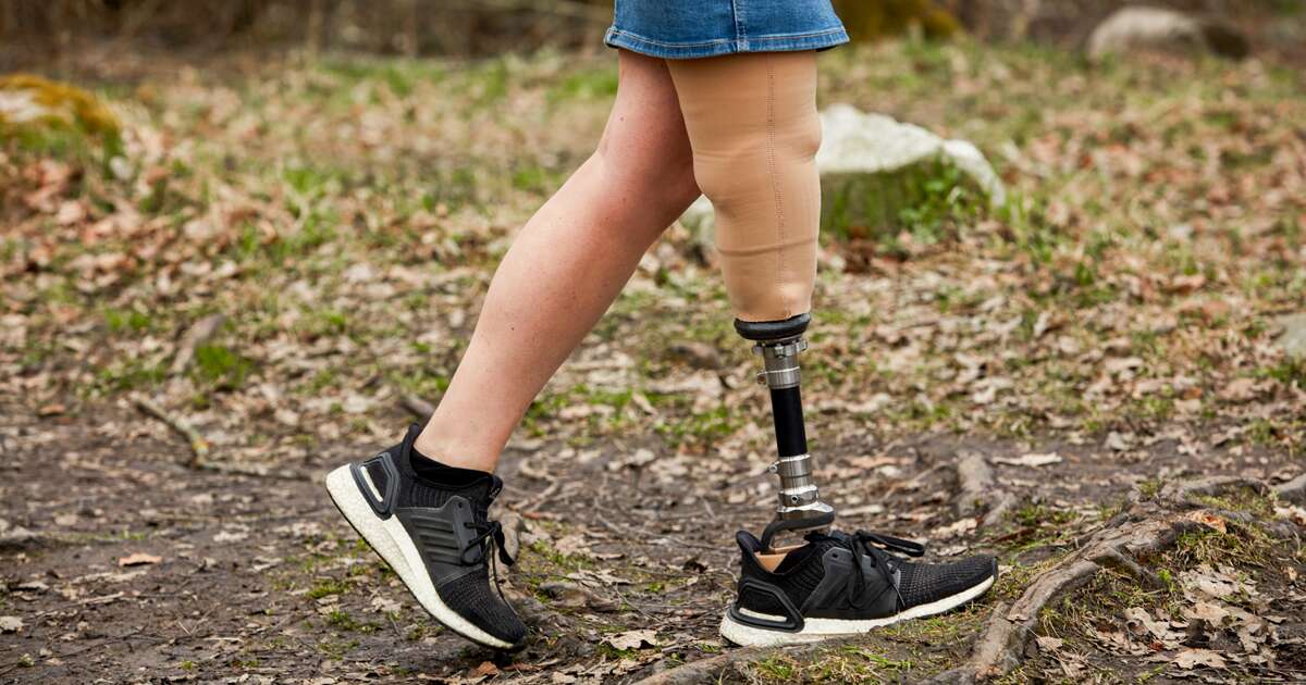 Management of the Amputated Foot with Meracus® Prosthetic | Hybrid ...